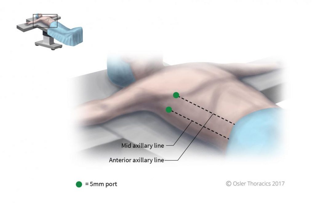 Bilateral VATS Endoscopic Thoracic Sympathectomy - Toronto Sweat Clinic
